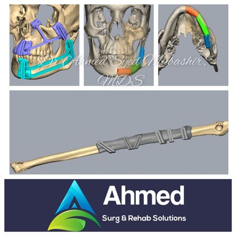 Ahmed Syed Mubashir On Linkedin Composite Maxilla And Mandible Resection Guide Followed By