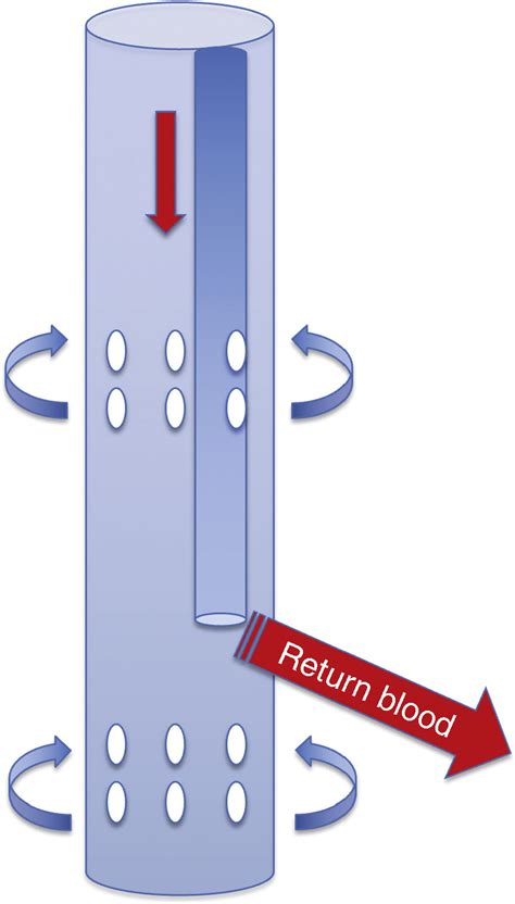 Ecmo Configurations Anesthesia Key