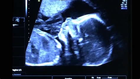Giving Birth Stock Footage Video Shutterstock