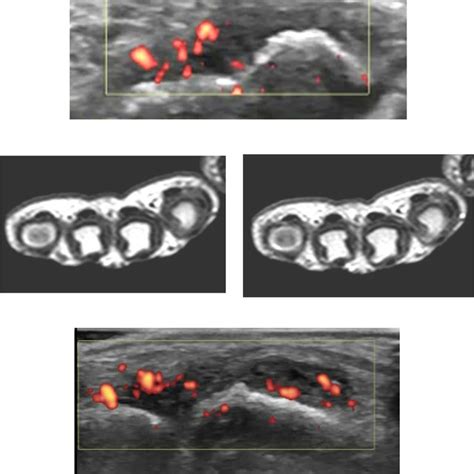 Dorsal Longitudinal Gs Scan Showing Scoring Of The Mcp Joint Synovitis