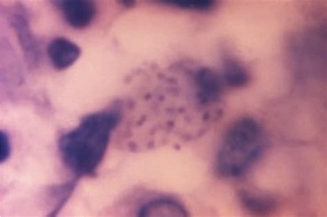 ALERT New Flesh Eating STD On The Loose