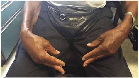 Ibm Inclusion Body Myositis Artofit