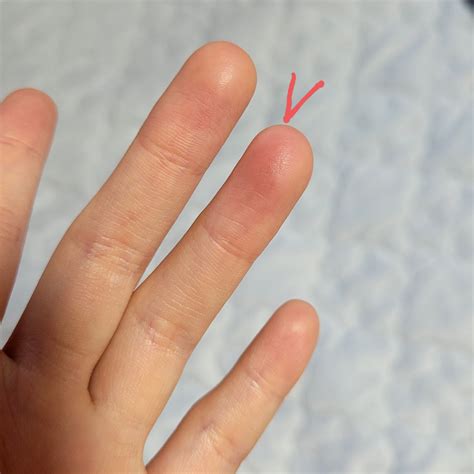 손가락에 빨간 반점같은게 생겼는데 뭔가요 ㅣ 궁금할 땐 아하