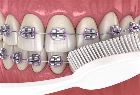 Step By Step Guide How To Brush And Floss Teeth With Braces