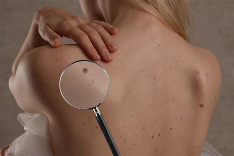How To Safely Remove Skin Tags Pure Holistic Beauty