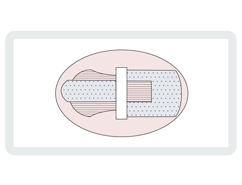 Securement Device Tillacare Uricap Female