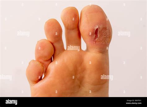 Open Blister On Big Toe Due To Flat Feet In Adult Male Isolated On