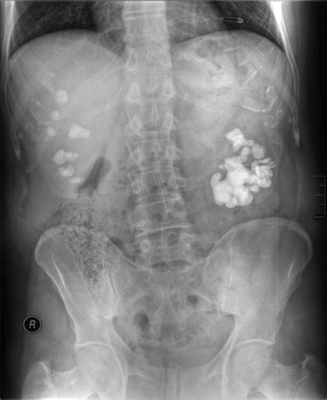 Abdominal X Ray Interpretation Axr Radiology Osce Geeky Medics