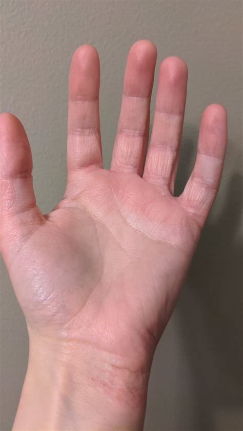 Possible Early Symptoms R Scleroderma