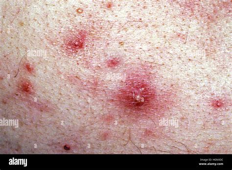 Pustules Hi Res Stock Photography And Images Alamy