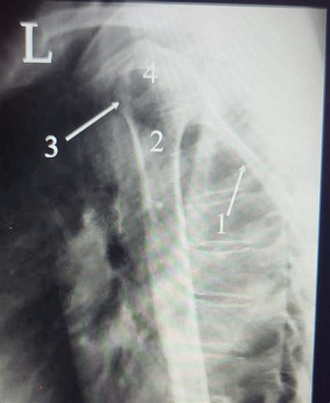 Transthoracic Shoulder Diagram Quizlet
