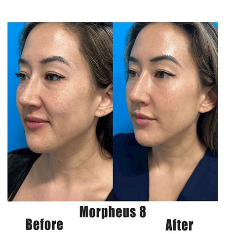 Does Morpheus8 Work Beyond Skin Medspa Blog