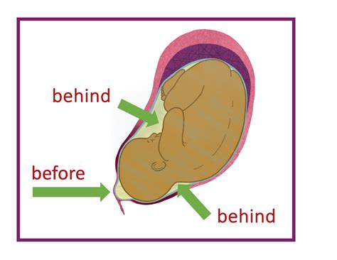 Breaking The Amniotic Sac