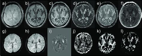 A Stroke Case 65y Male With Cerebral Microbleeds Scanned With Download Scientific Diagram