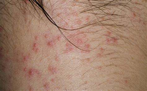 hiv皮肤症状 iv症状皮疹图片 iv症状图片 第8页 大山谷图库
