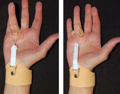 All PIP Joint Flexion Contractures Are Not The Same