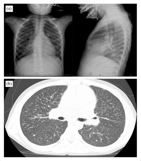A Chest Radiograph Showing Bilateral Tiny Nodular Shadows B