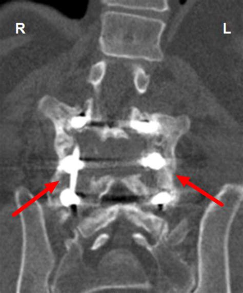 Spinal Fusion Dr Justin Smith