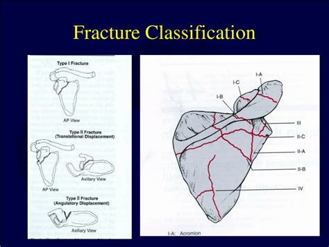 Scapular Fracture Classification Animation Everything