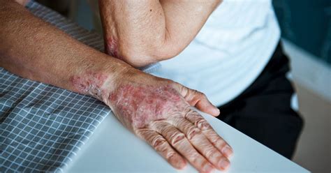 8 Ways To Treat Cracks And Bleeding From Psoriasis On The Hands