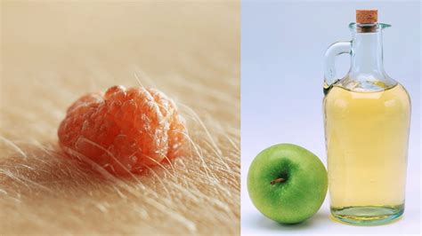 Как быстро и легко удалить папилломы в домашних условиях Youtube