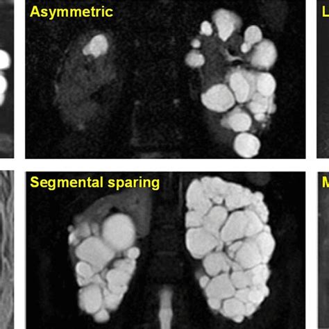 Illustrations Of Atypical Imaging Patterns These Include Unilateral