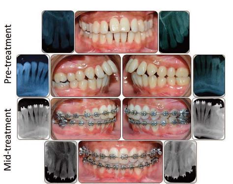 Orthodontic Treatment And Periodontal Disease At Clifford Bloss Blog