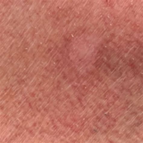 Cryotherapy Cryosurgery Estheva Medical Aesthetic Clinic