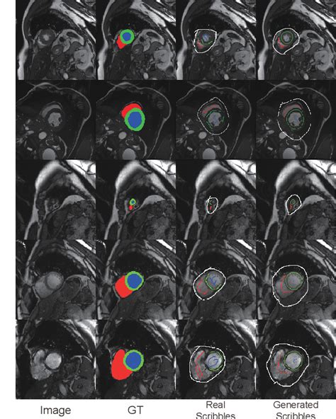 Figure 11 From Volumetric Medical Image Segmentation Via Scribble