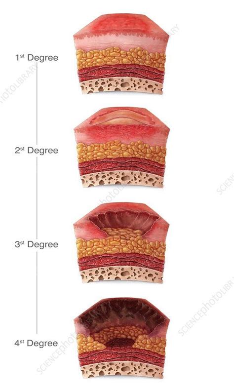 Sunburn Severity Chart Google Search Layers Of Skin Epidermis Degree Burns