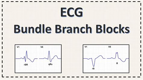 Medial Bundle Branch Block