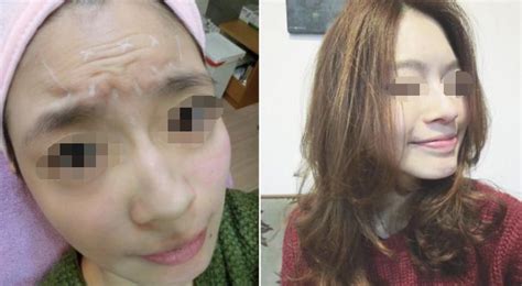 额头皱纹怎么去除？不同的原因，治疗方法也不同 知乎