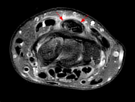 Stenosing Tenosynovitis Of The 4th Extensor Compartment Radsource
