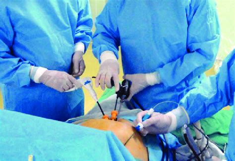 A When Conflicts Occur The Laparoscope Cannot Come Close To The Tip Download Scientific