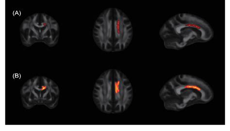 Figure 2 From Whole Brain And Corpus Callosum Diffusion Tensor Metrics