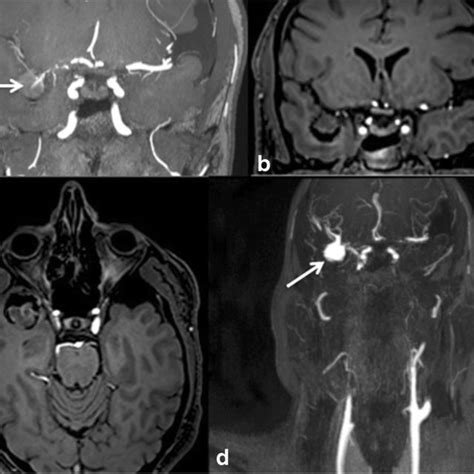 After Endovascular Treatment Of The Right Ica Supraclinoid Segment