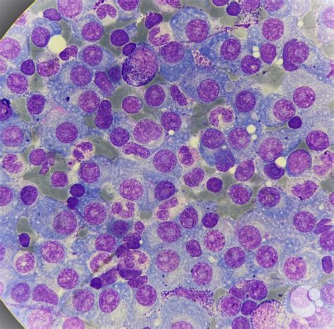 Plasma Cell 2