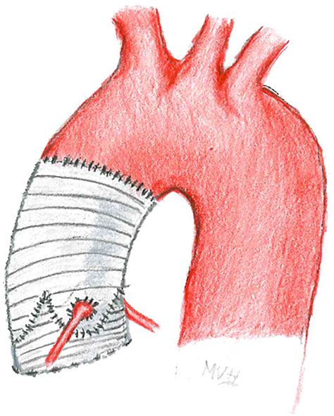 Aortic Valve Sparing Root Replacement David Operation Download Scientific Diagram