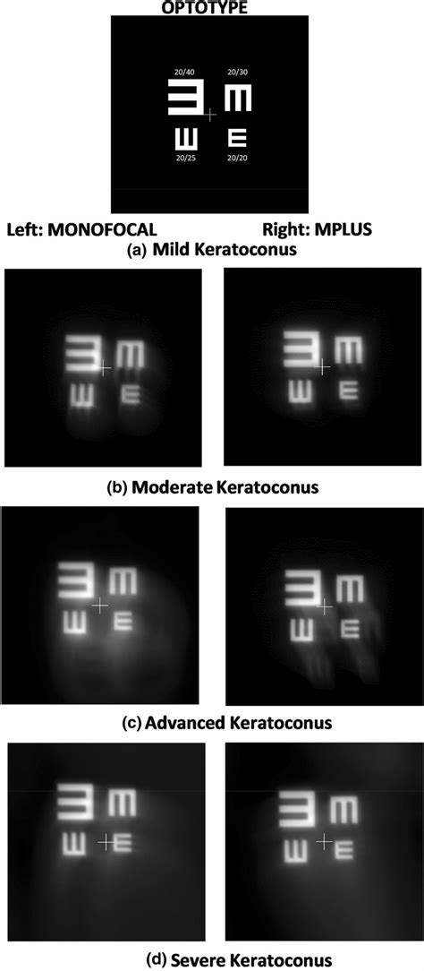What Is An Optotype At Ava Lazarev Blog
