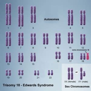 Science In The News Trisomy 18 Edwards Syndrome
