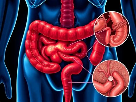 Appendicitis And Peritonitis Causes Symptoms And Treatment Options