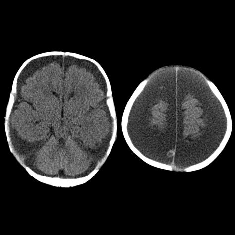 Pediatric Subdural Hematoma Pediatric Radiology Reference Article