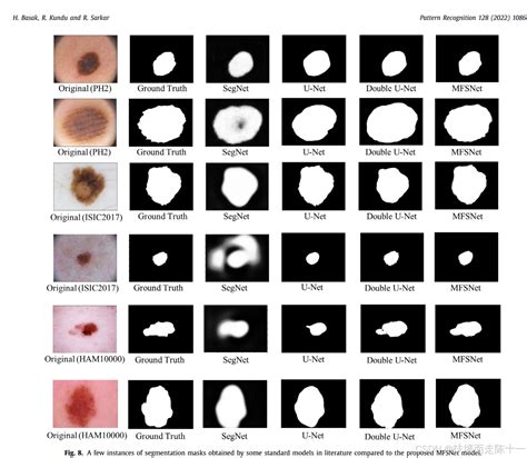 Mfsnet A Multi Focus Segmentation Network For Skin Lesion Segmentation Csdn博客