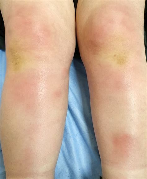 Differential Diagnosis Erythema Nodosum At Vivian Beck Blog