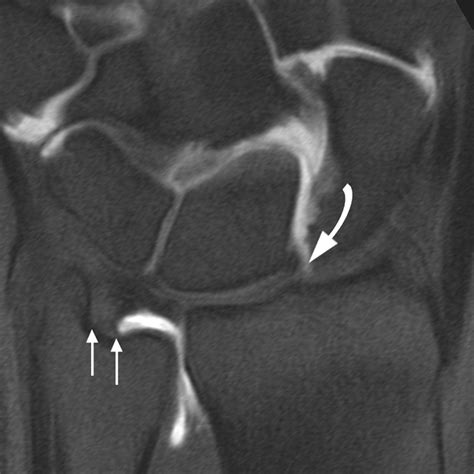 Triangular Fibrocartilage Complex Tfcc Injuries James