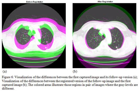 Automatic Pulmonary Nodule Growth Measurement Through Ct Image Analysis Based On Morphology