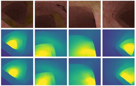 Researchers Used Machine Learning To Increase Coverage In Colonoscopy Screenings