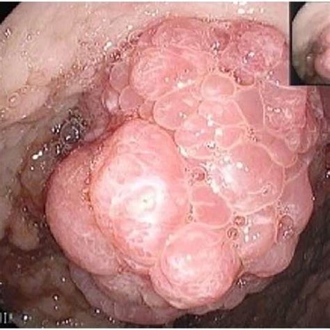 Gastric Mucosa With Multiple Polypoid Lesions Download Scientific