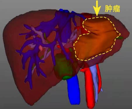 哈医大一院肝脏微创外科加班加点为患者尽早解除病痛 哈尔滨医科大学新闻网