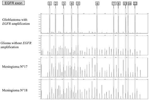 Egfr Gene Amplification Genomic Dnas From Glioma With And Without Egfr Download Scientific